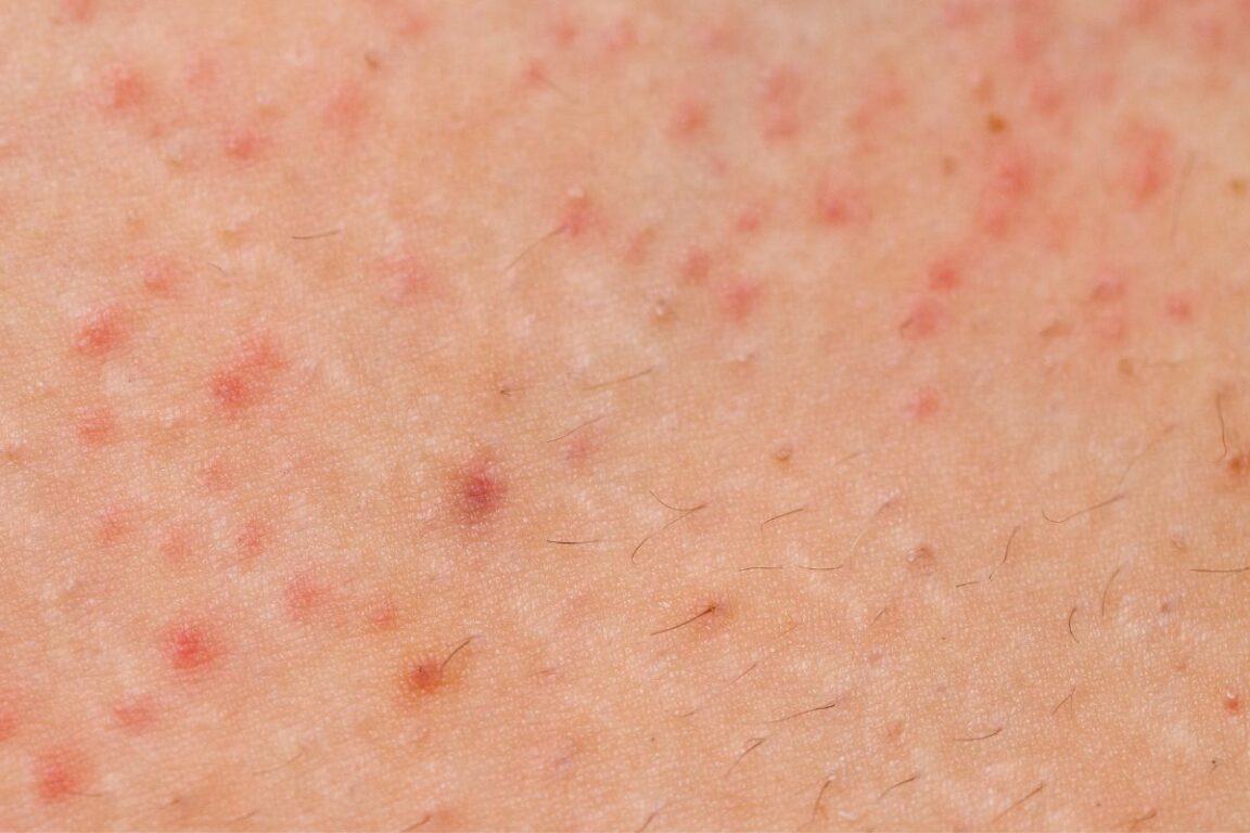 White Pus Bumps After Brazilian Wax: How To Fix Them - Luxe Luminous